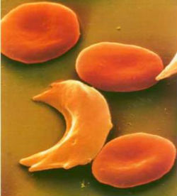 Hopeful new research for sickle cell disease - Health & Wellness - News ...