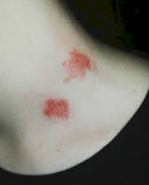 Teen dies from HICKEY - Why sexual education is important for Catholic ...