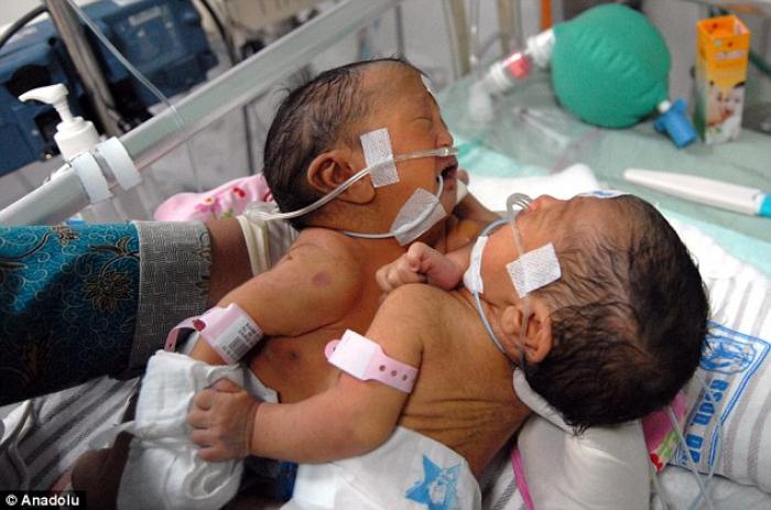 Rare conjoined twins born in Indonesia with attached chest, abdomen ...